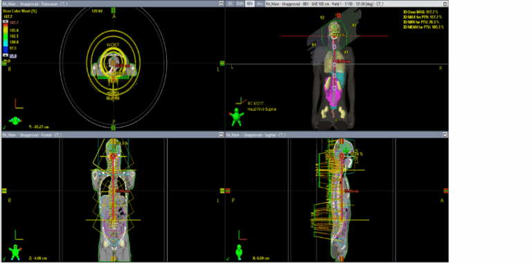 Radiation planning and treatment with multiple iso-center VMAT arc and ...